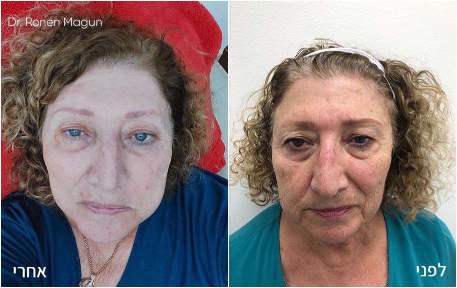 פילינג לייזר עם או בלי פציעה - ד"ר רונן מגון